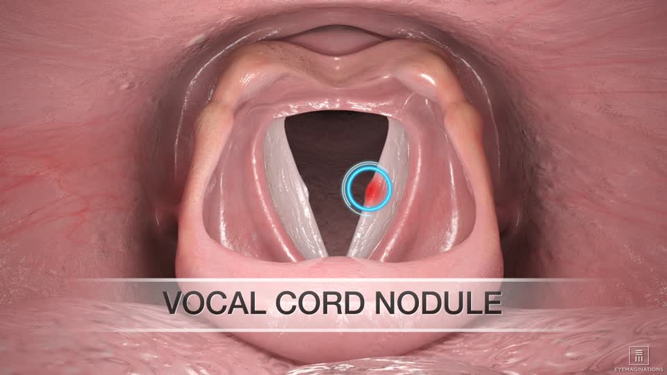 Vocal Cord Nodules San Diego Polyps Chula Vista